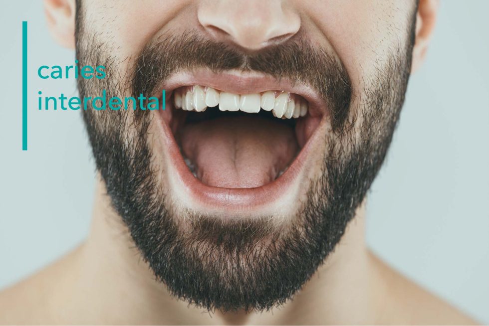 PREVENCIÓN CARIES INTERDENTAL EN MENORCA - Clínica Mo
